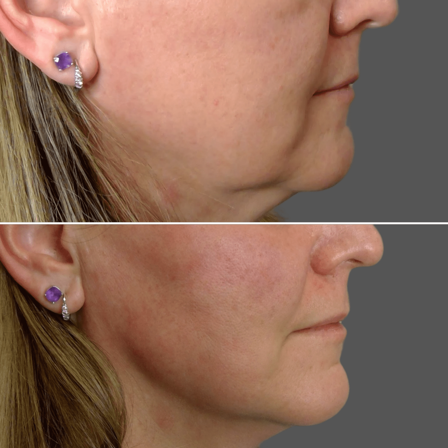 PDO Thread Lifts in Grand Rapids, MI | Proper Eu