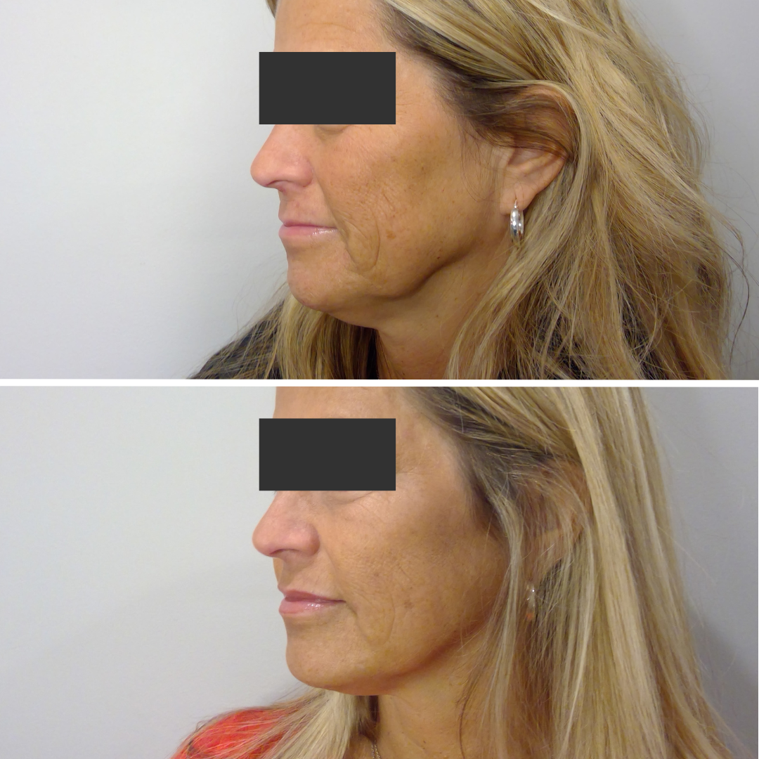 PDO Thread Lifts in Grand Rapids, MI | Proper Eu